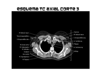 Anatomia radiologica de_torax_parte_2 | PPT