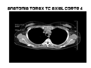 Anatomia radiologica de_torax_parte_2 | PPT