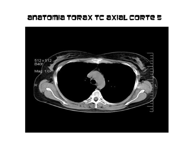 Anatomia radiologica de_torax_parte_2 | PPT