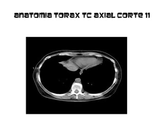 Anatomia radiologica de_torax_parte_2 | PPT