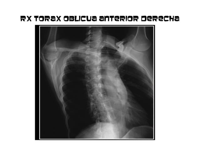 Anatomia radiologica de_torax_parte_2 | PPT