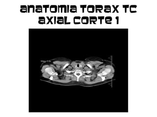 Anatomia radiologica de_torax_parte_2 | PPT