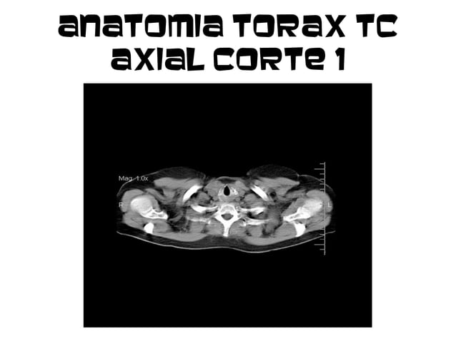 Anatomia radiologica de_torax_parte_2 | PPT