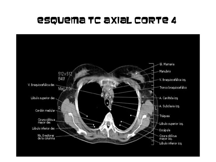 Anatomia radiologica de_torax_parte_2
