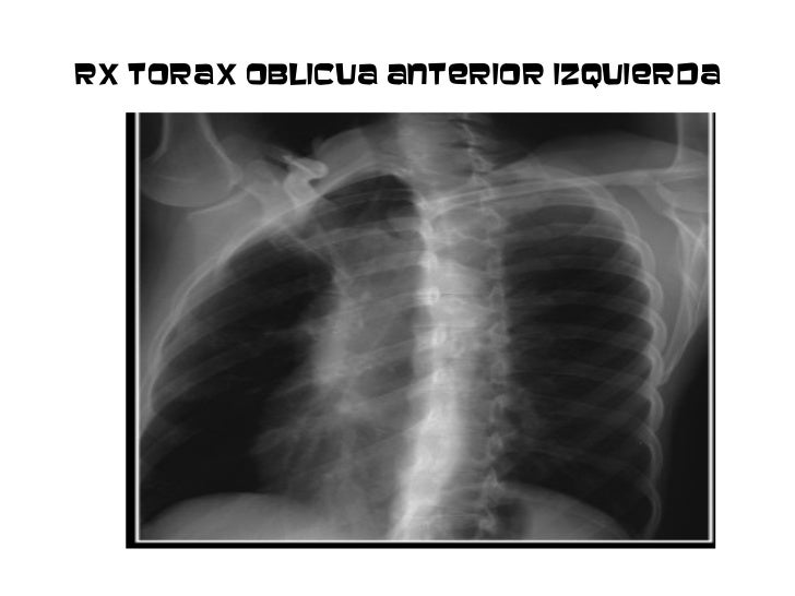 Anatomia radiologica de_torax_parte_2
