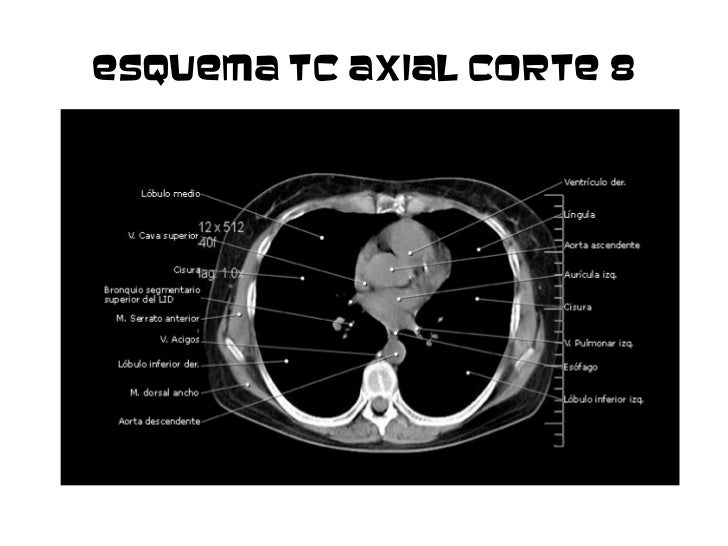 Anatomia radiologica de_torax_parte_2