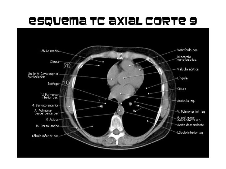 Anatomia radiologica de_torax_parte_2