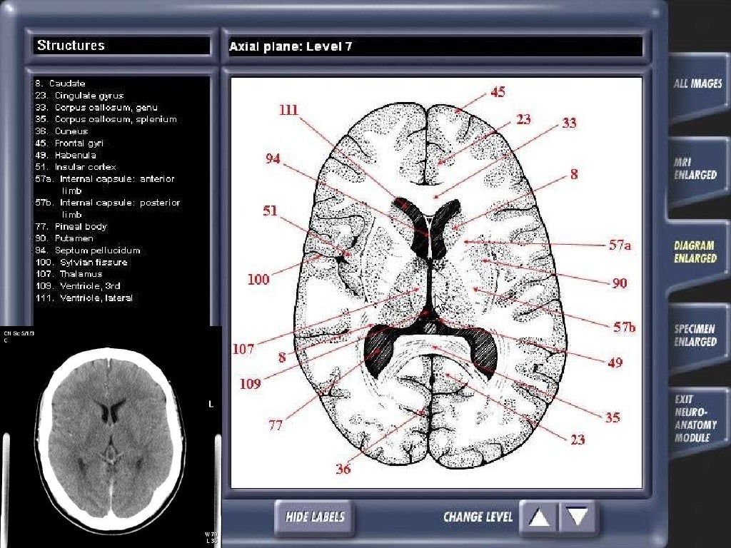 Anatomia Seccional do Crâneo em Tomografia Computadorizada