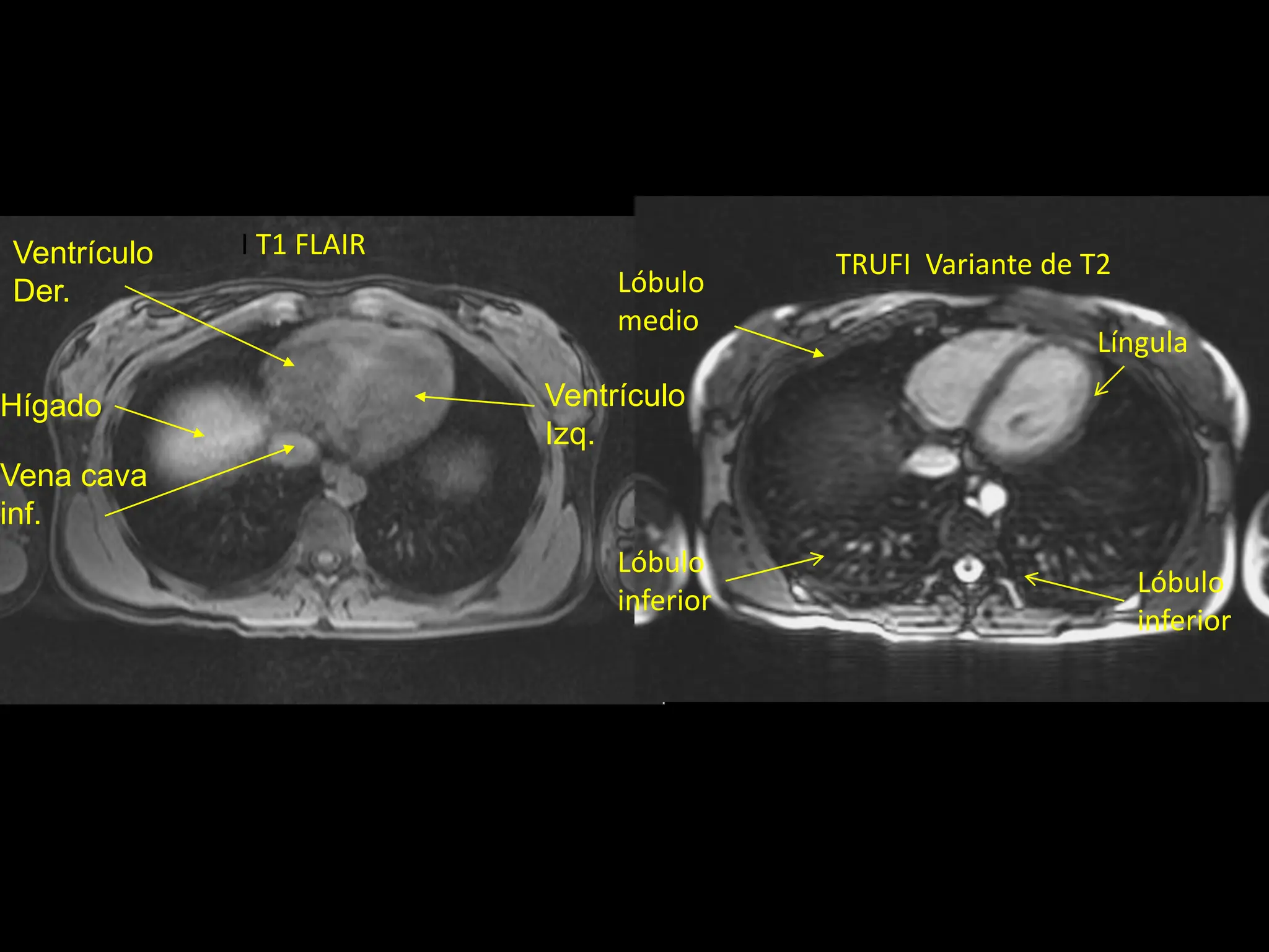anatomia seccional de torax por rm_250303_151255.pdf