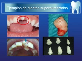 Dientes supernumerarios | PPTX