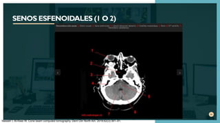 ANATOMIA TOMOGRAFICA DE CARA CIRUGA ORLAY MAXILOFACIAL.pptx