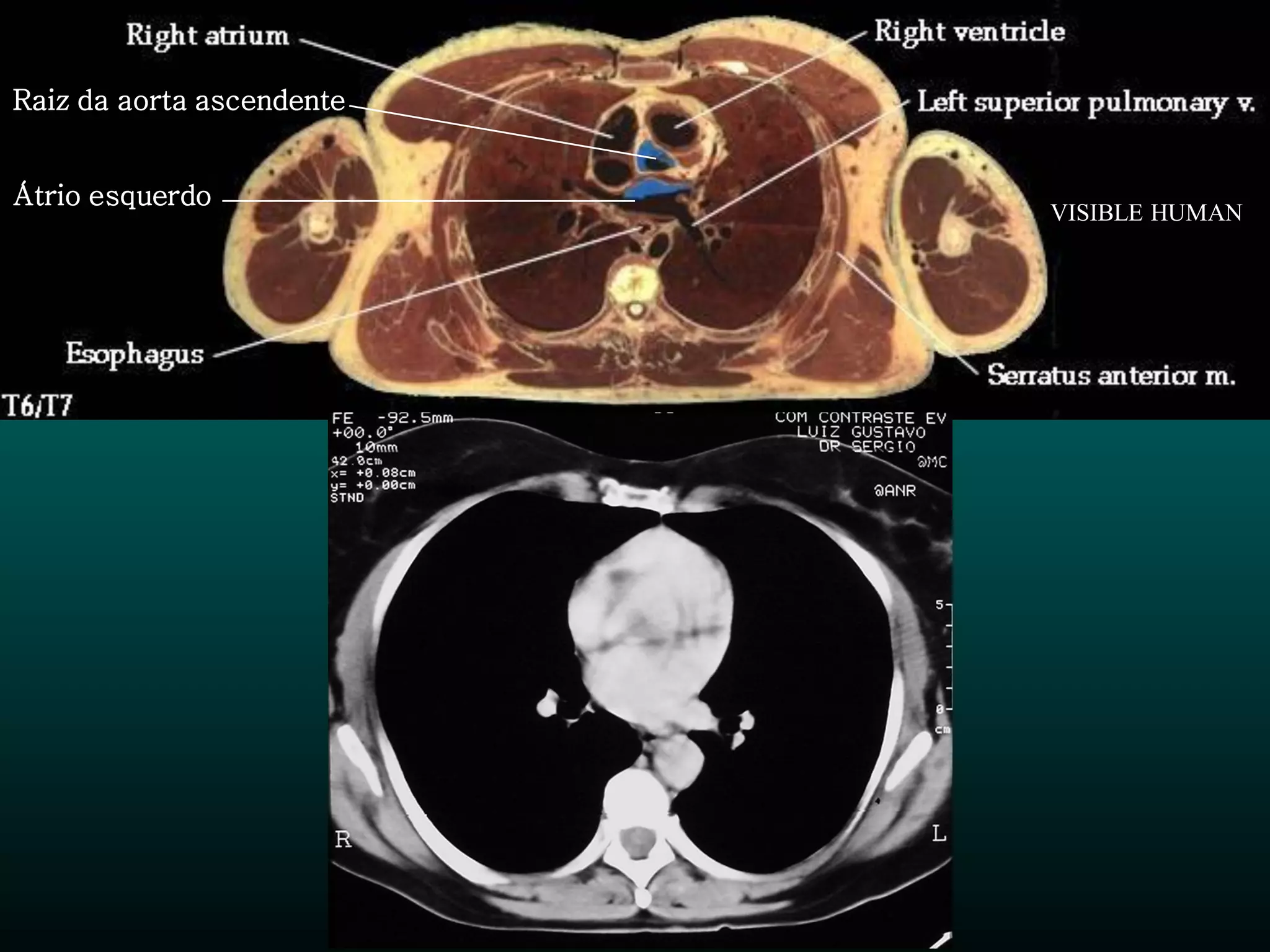 Anatomia tomografica do torax | PDF