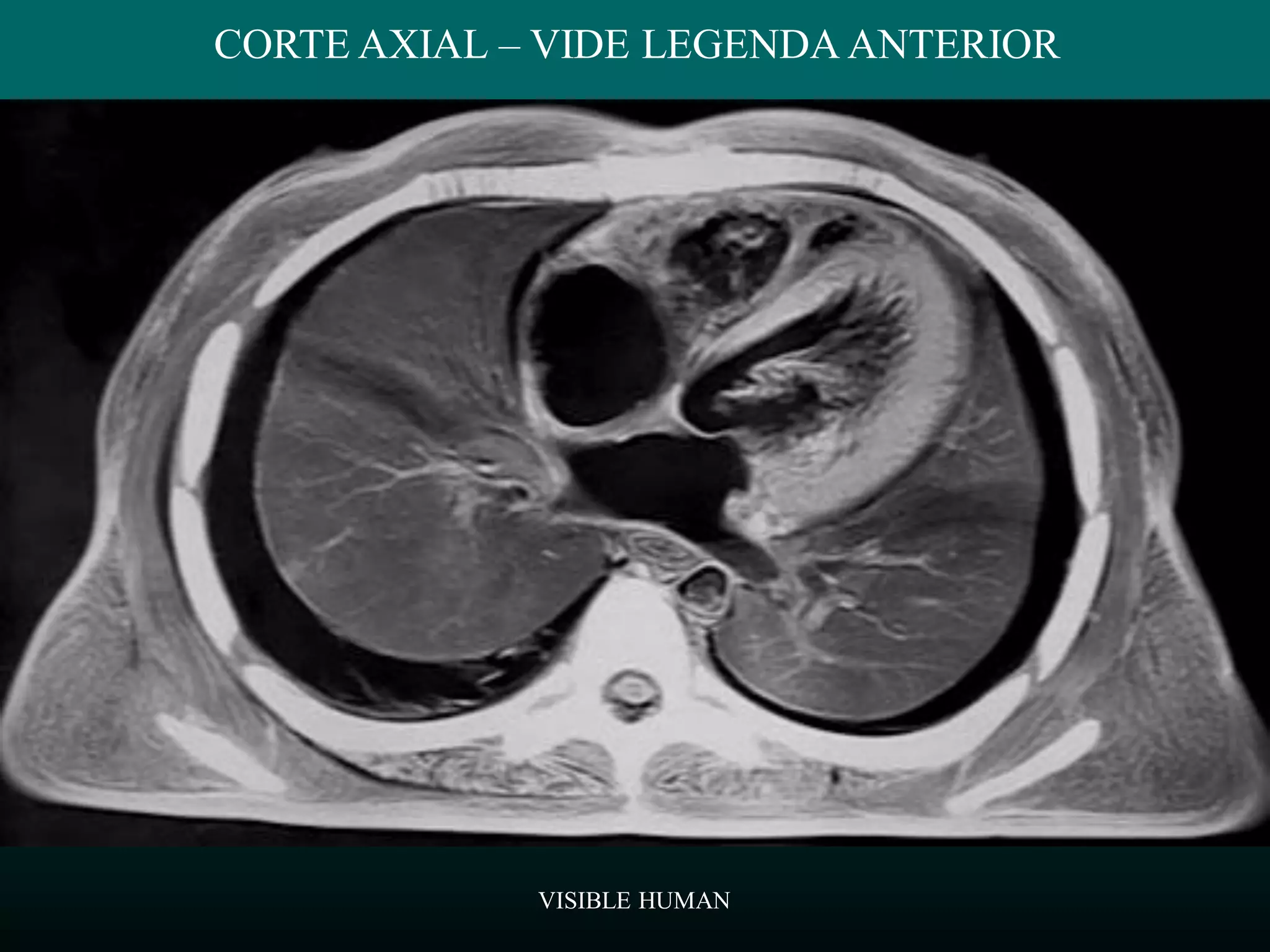 Anatomia tomografica do torax | PDF