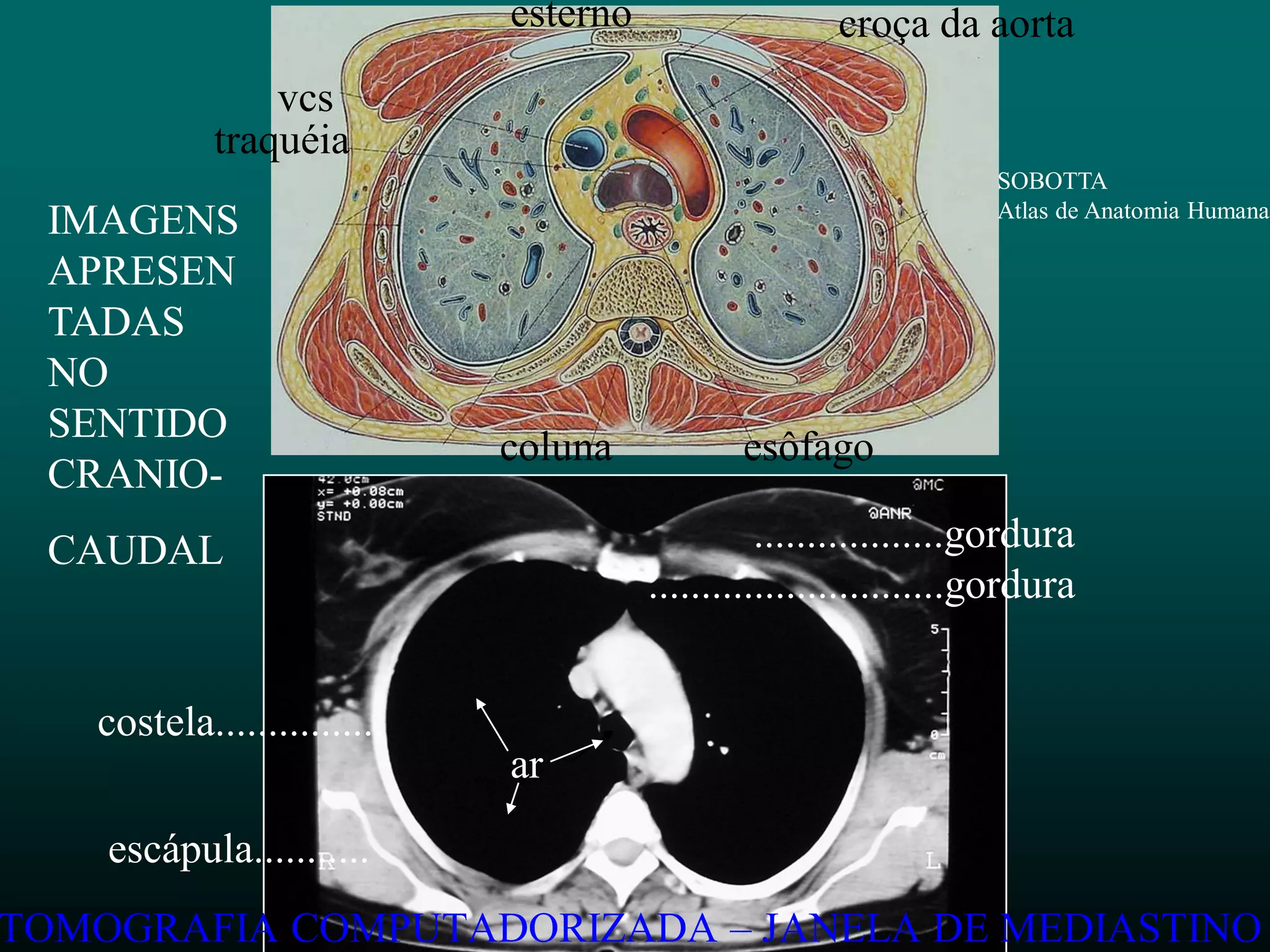 Anatomia tomografica do torax | PDF