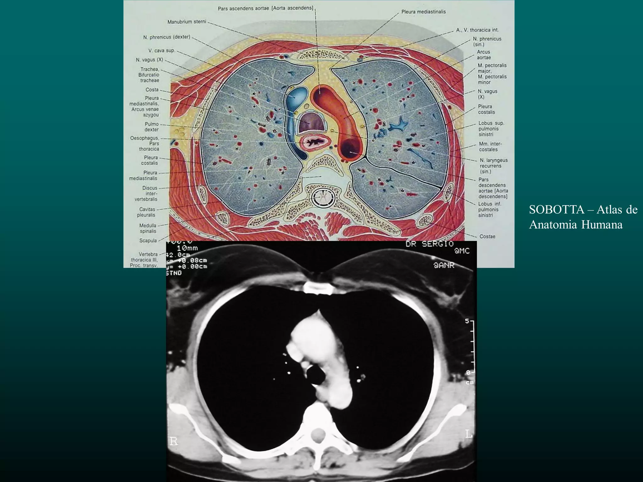 Anatomia tomografica do torax | PDF