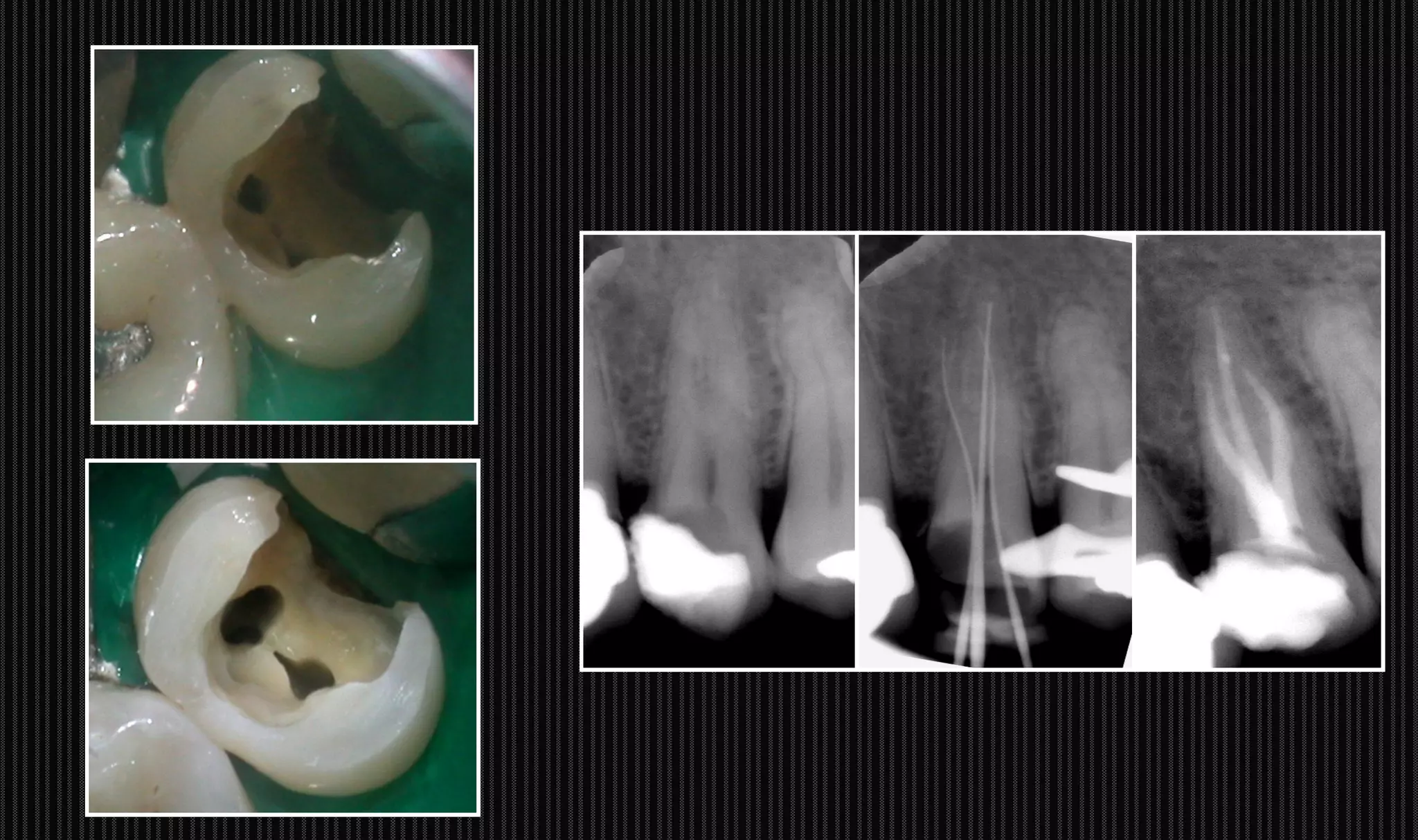 Anatomía y Apertura Cameral. | PPT | Ear, Nose and Throat Conditions ...