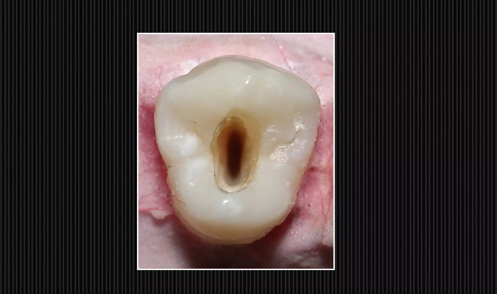 Anatomía y Apertura Cameral. | PPT | Ear, Nose and Throat Conditions ...