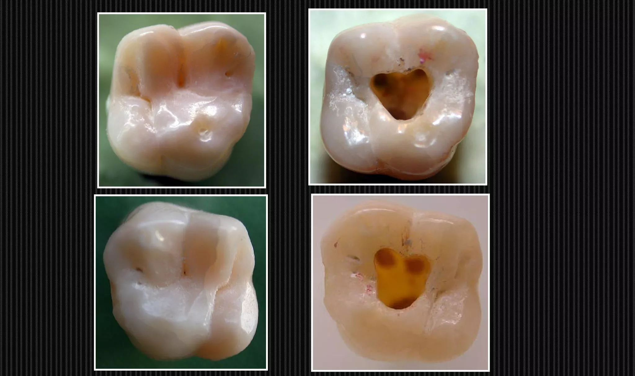 Anatomía y Apertura Cameral. | PPT | Ear, Nose and Throat Conditions ...