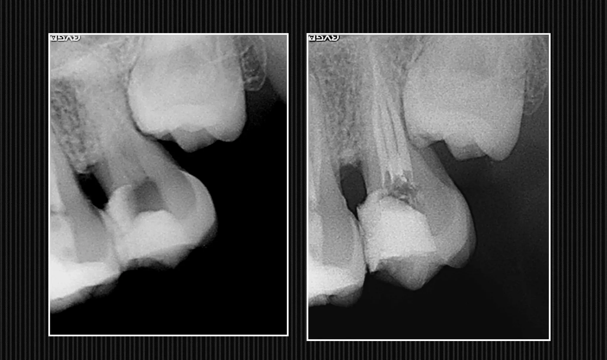 Anatomía y Apertura Cameral. | PPT | Ear, Nose and Throat Conditions ...