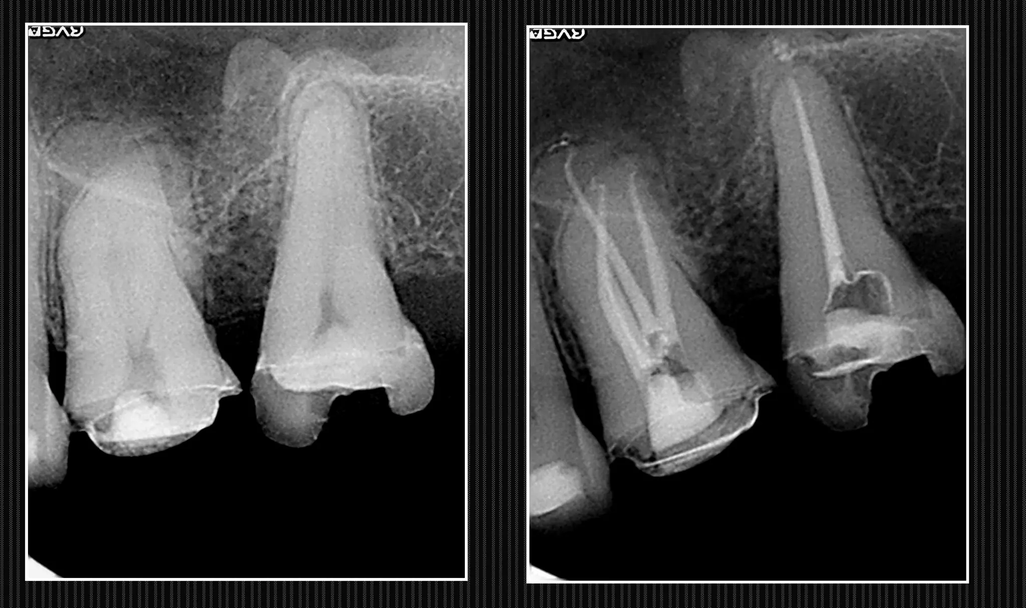 Anatomía y Apertura Cameral. | PPT | Ear, Nose and Throat Conditions ...