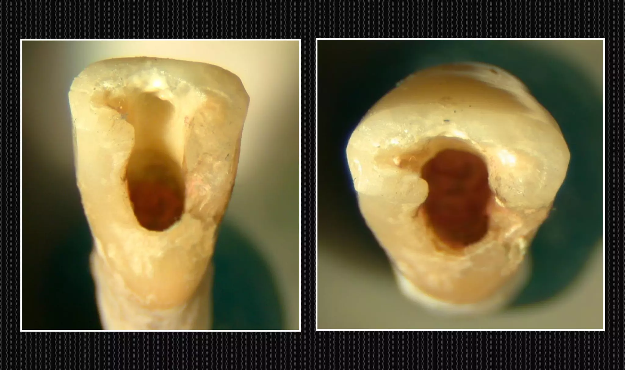 Anatomía y Apertura Cameral. | PPT | Ear, Nose and Throat Conditions ...