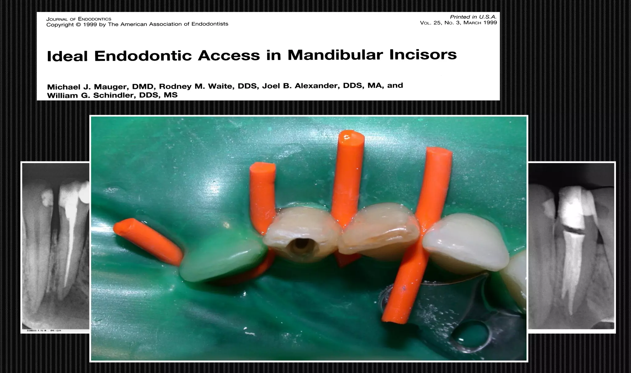 Anatomía y Apertura Cameral. | PPT | Ear, Nose and Throat Conditions ...