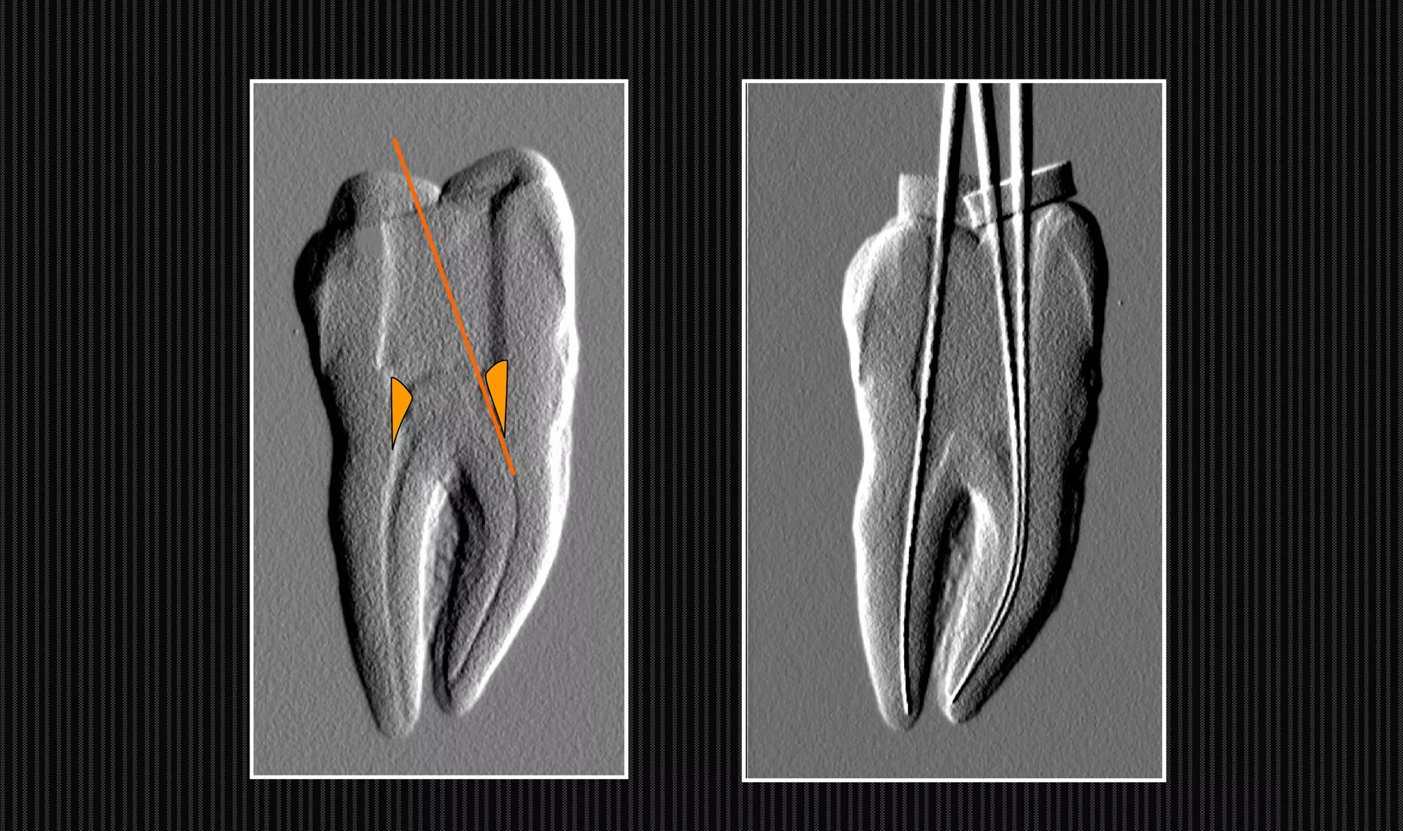 Anatomía y Apertura Cameral. | PPT | Ear, Nose and Throat Conditions ...