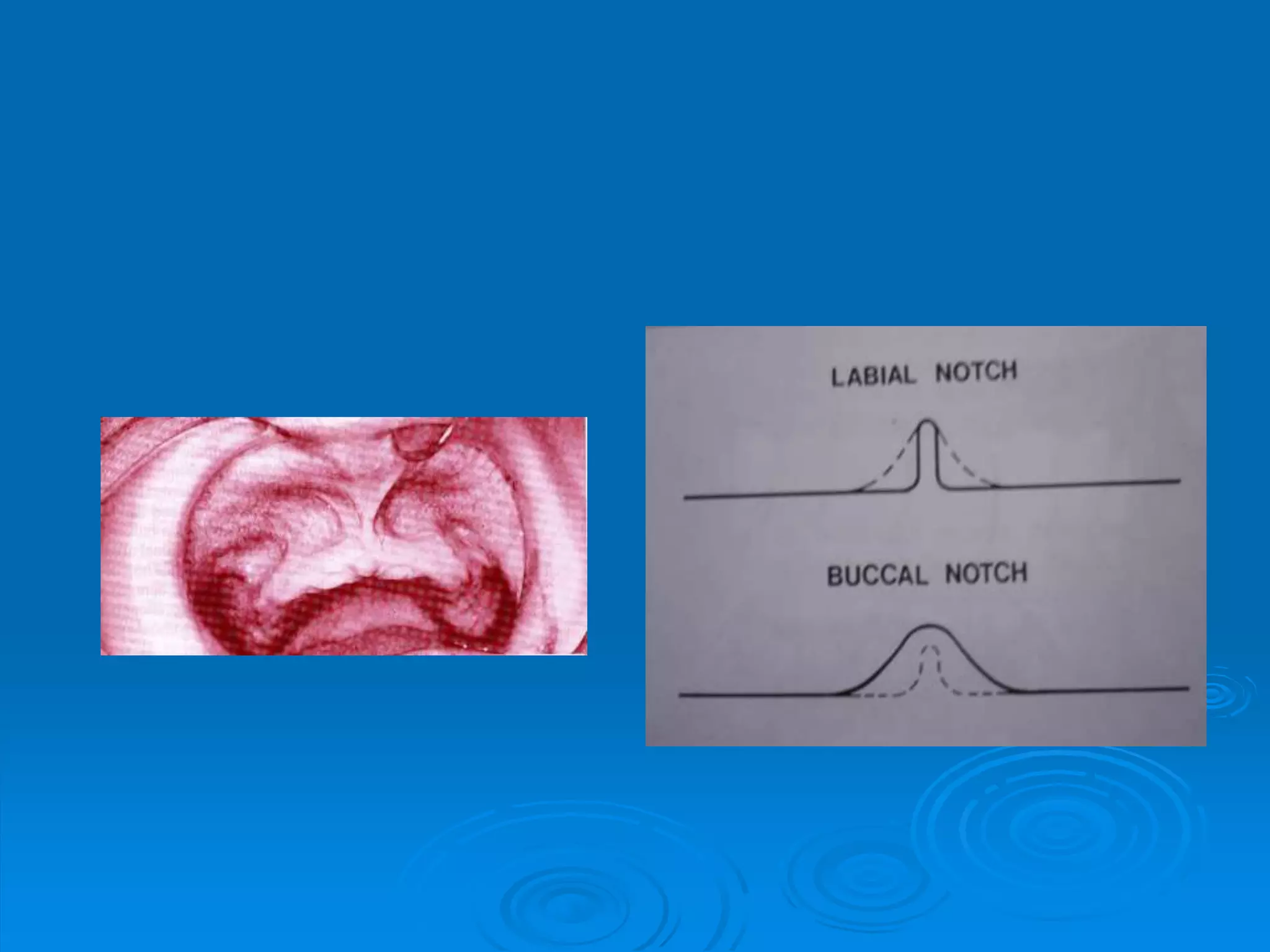 maxillary anatomical landmarks | PPT