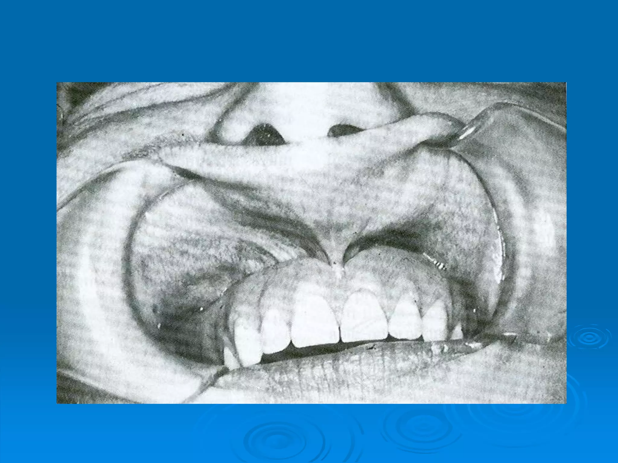 maxillary anatomical landmarks | PPT
