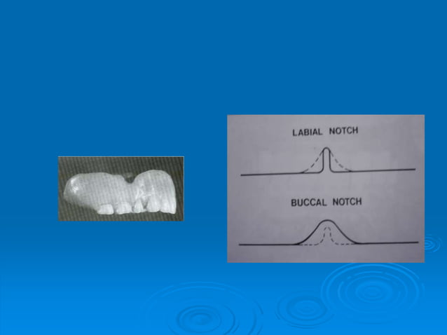 maxillary anatomical landmarks | PPT | Dental Health | Diseases and ...