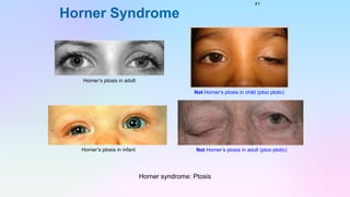 Anatomical basis of Horner’s syndrome.pptx
