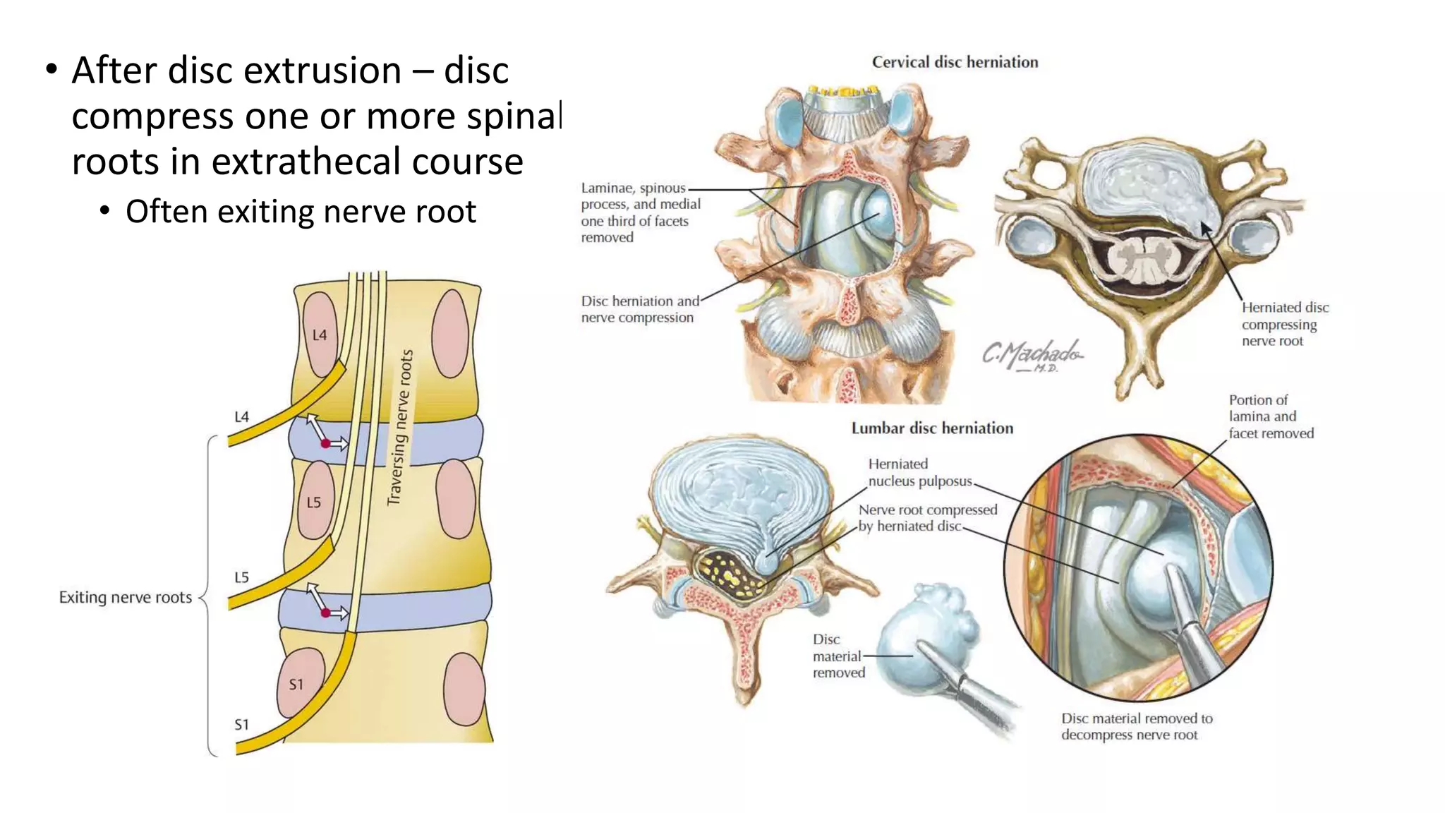 Anatomical basis of common back problems | PPTX