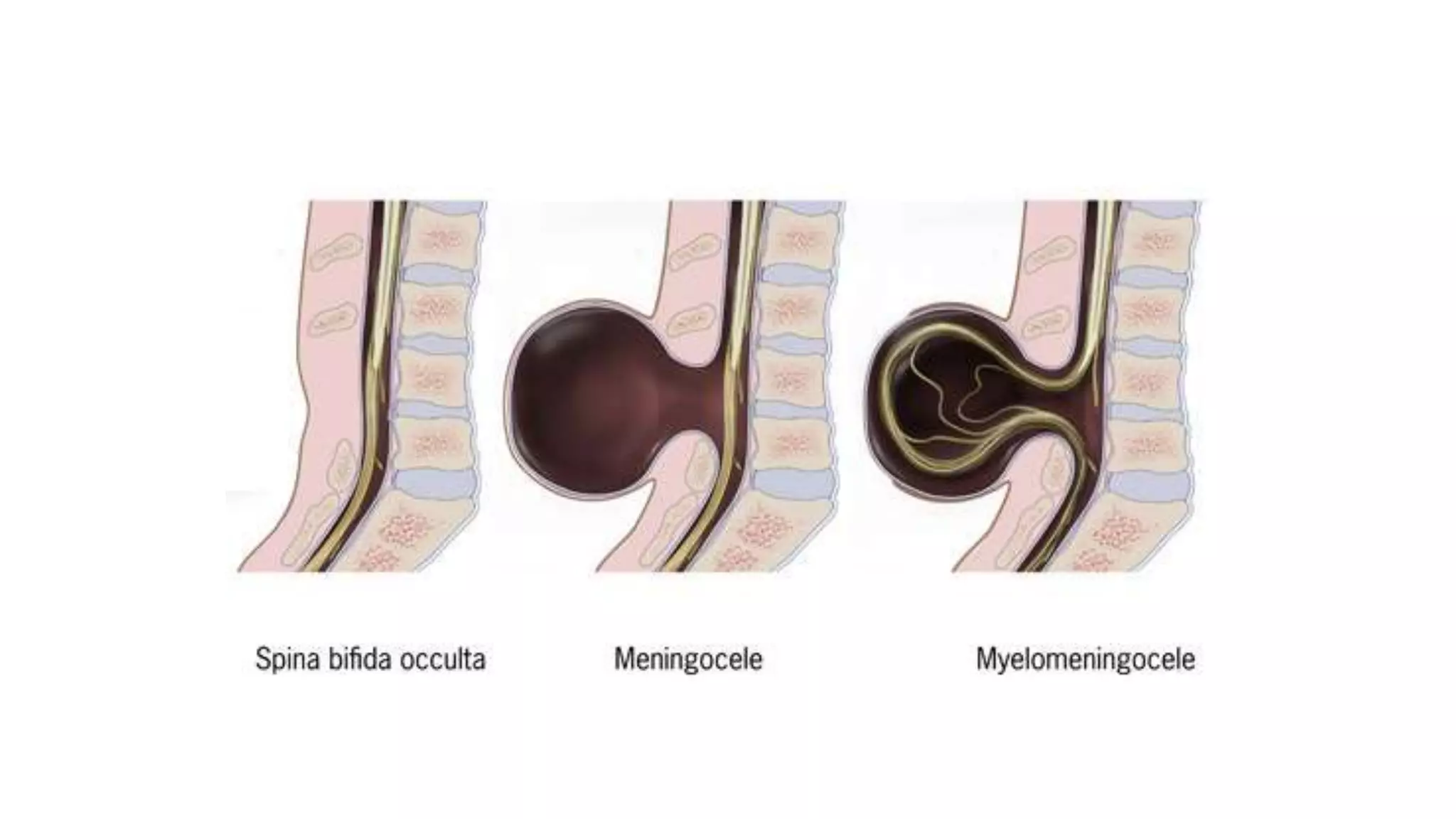 Anatomical basis of common back problems | PPTX