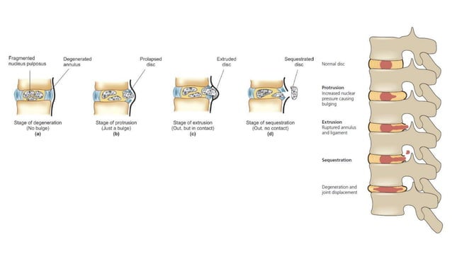 Anatomical basis of common back problems | PPT