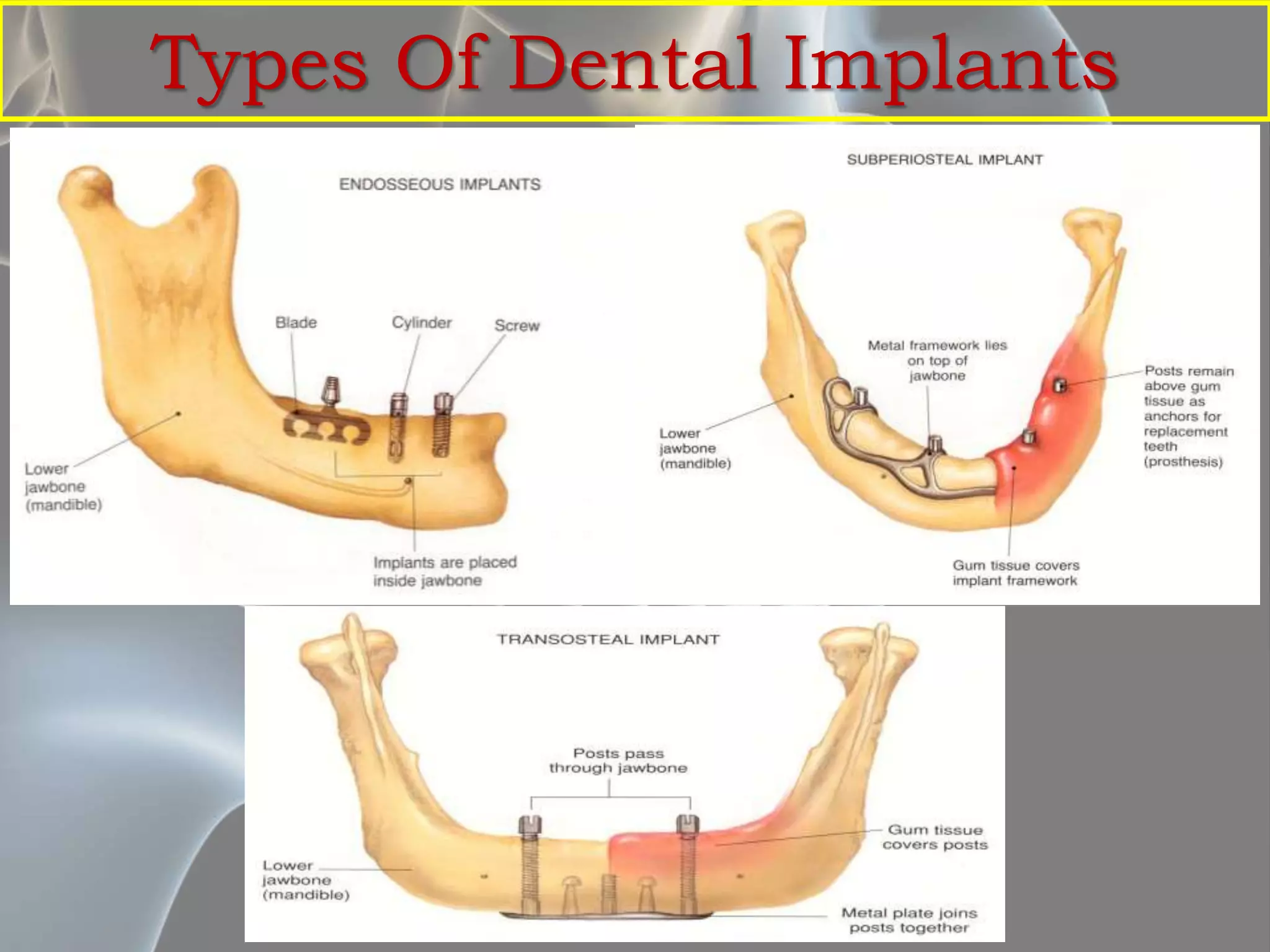 Anatomical considerations for dental implants | PPTX