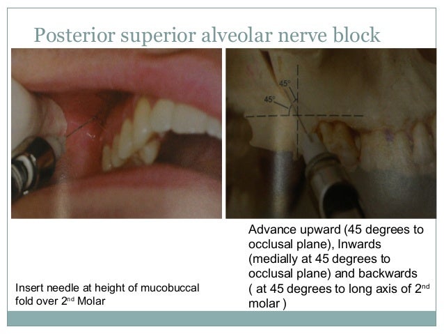 Posterior Superior Alveolar Nerve Block