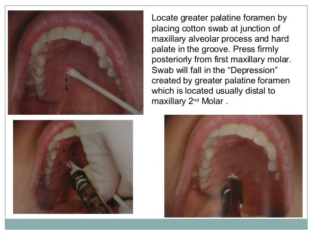 Anatomical correlation of local anesthesia in dentistry