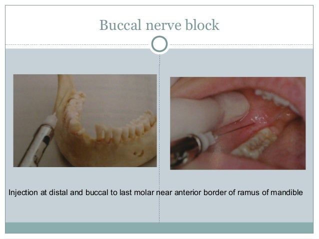 Anatomical correlation of local anesthesia in dentistry