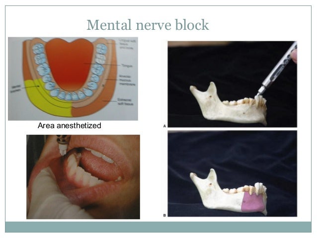 Anatomical correlation of local anesthesia in dentistry