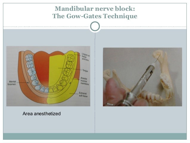 Anatomical correlation of local anesthesia in dentistry