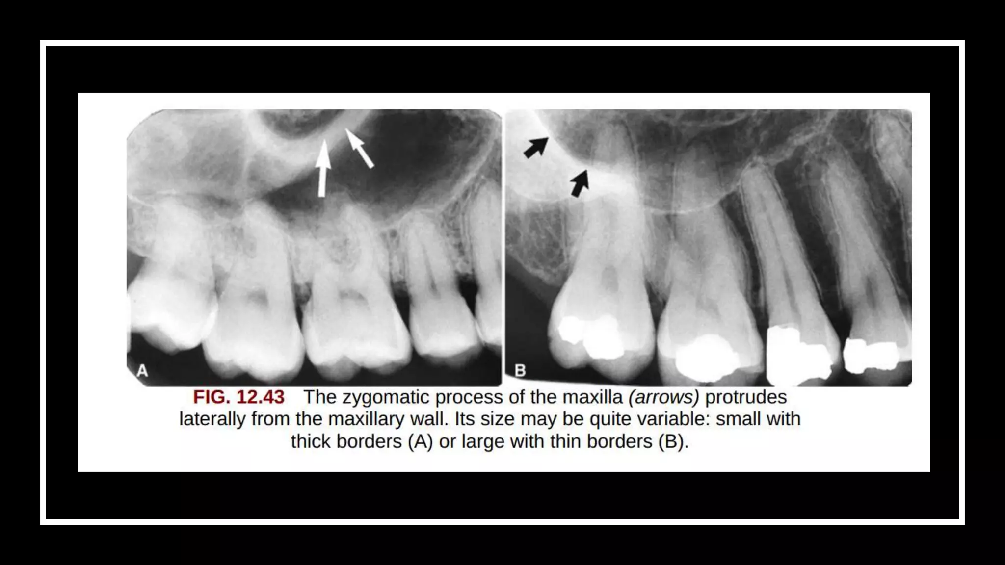 Anatomical landmark in oral radiology | PPTX