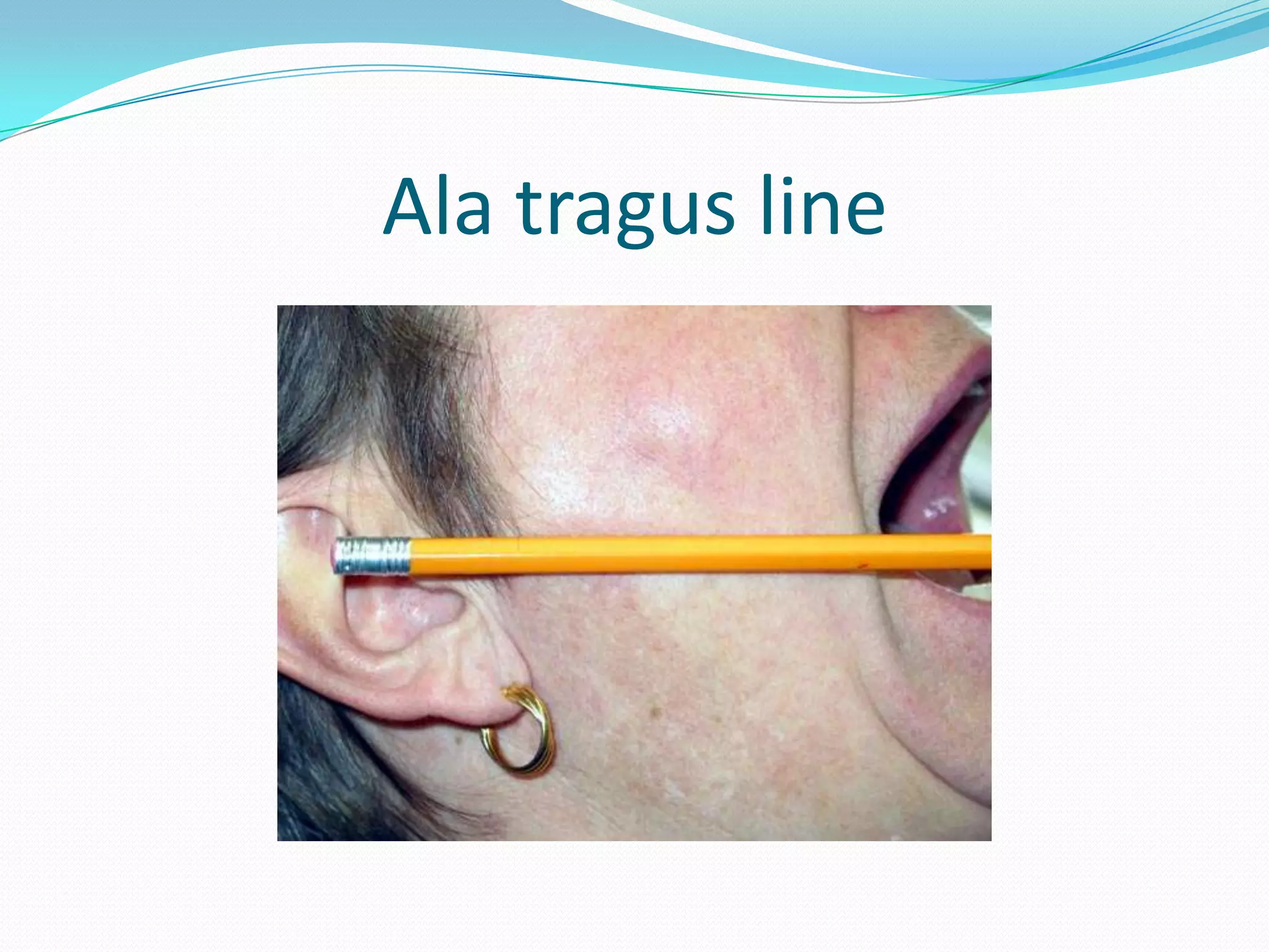 Anatomical Landmarks for Complete Dentures | PPTX