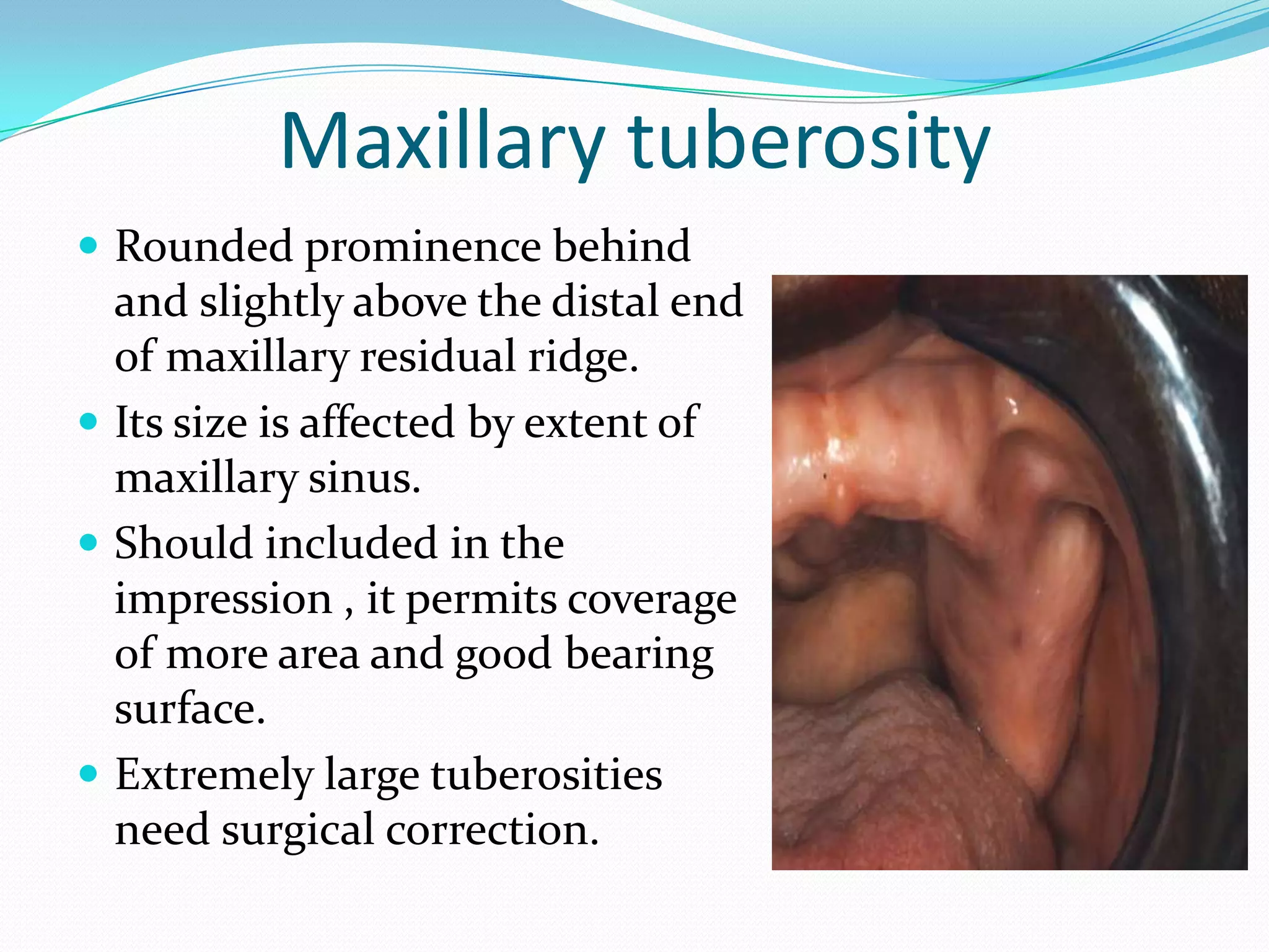 Anatomical Landmarks for Complete Dentures | PPTX