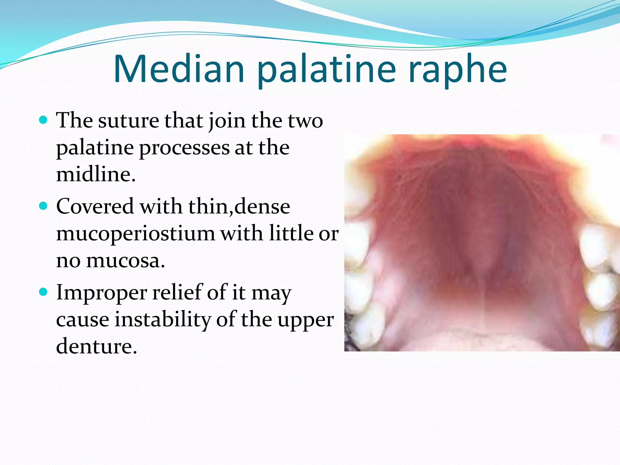 Anatomical Landmarks for Complete Dentures | PPTX