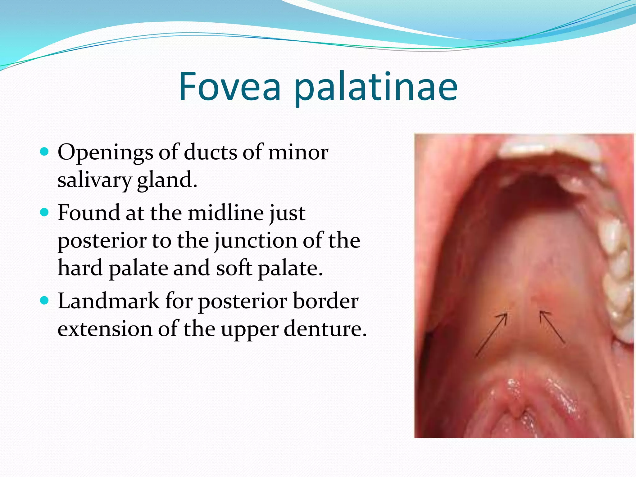 Anatomical Landmarks for Complete Dentures | PPTX