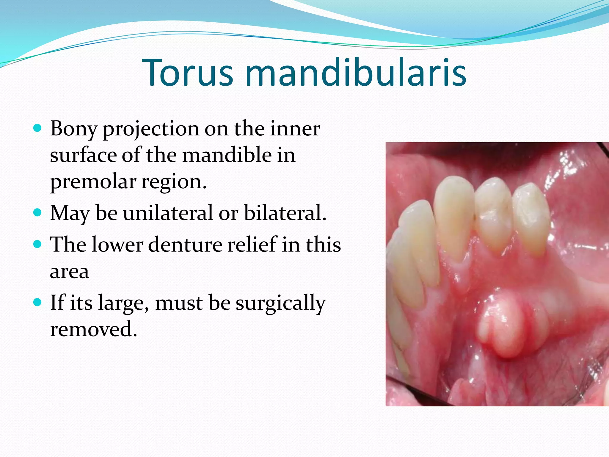 Anatomical Landmarks for Complete Dentures | PPTX