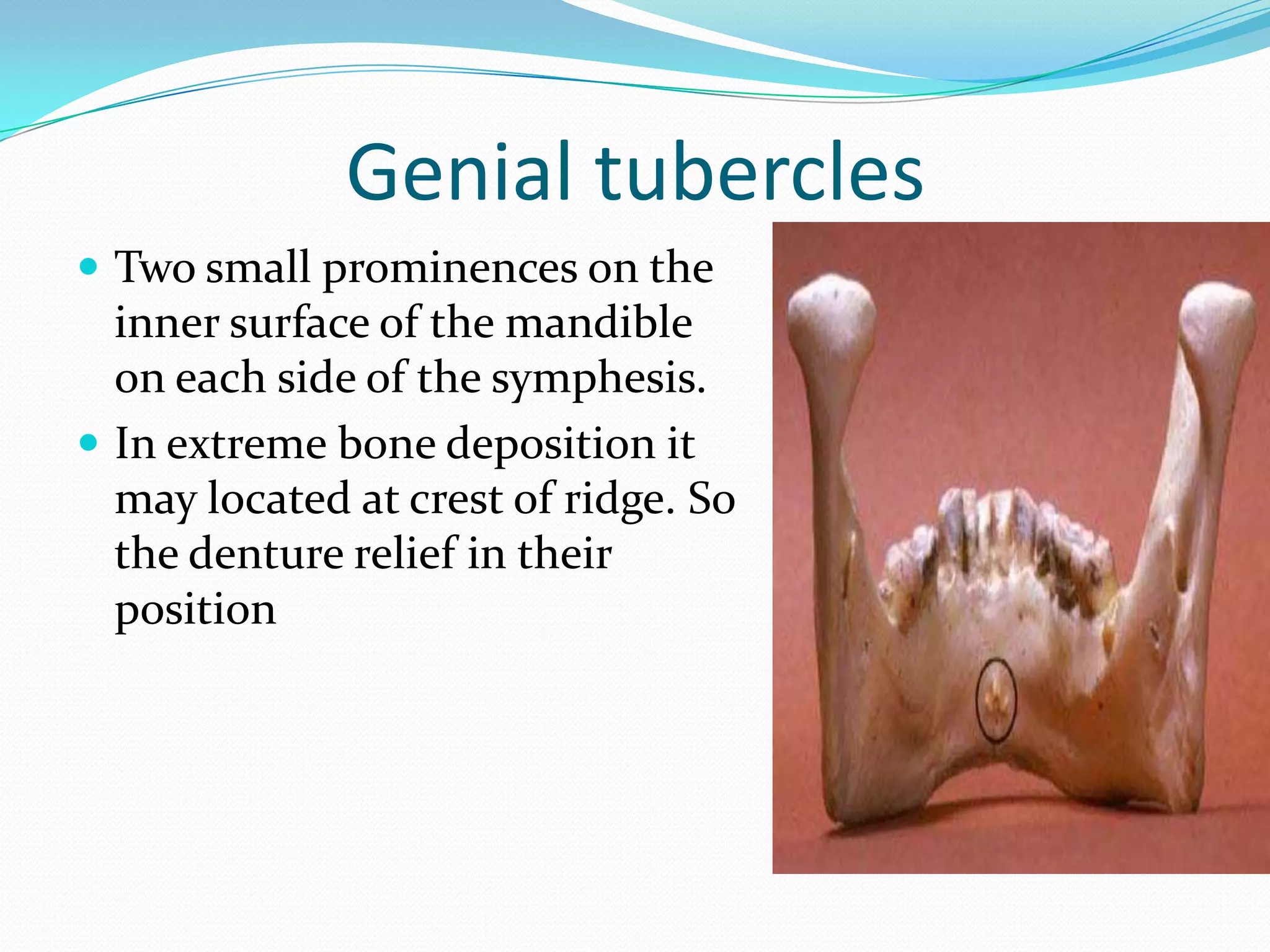 Anatomical Landmarks for Complete Dentures | PPTX