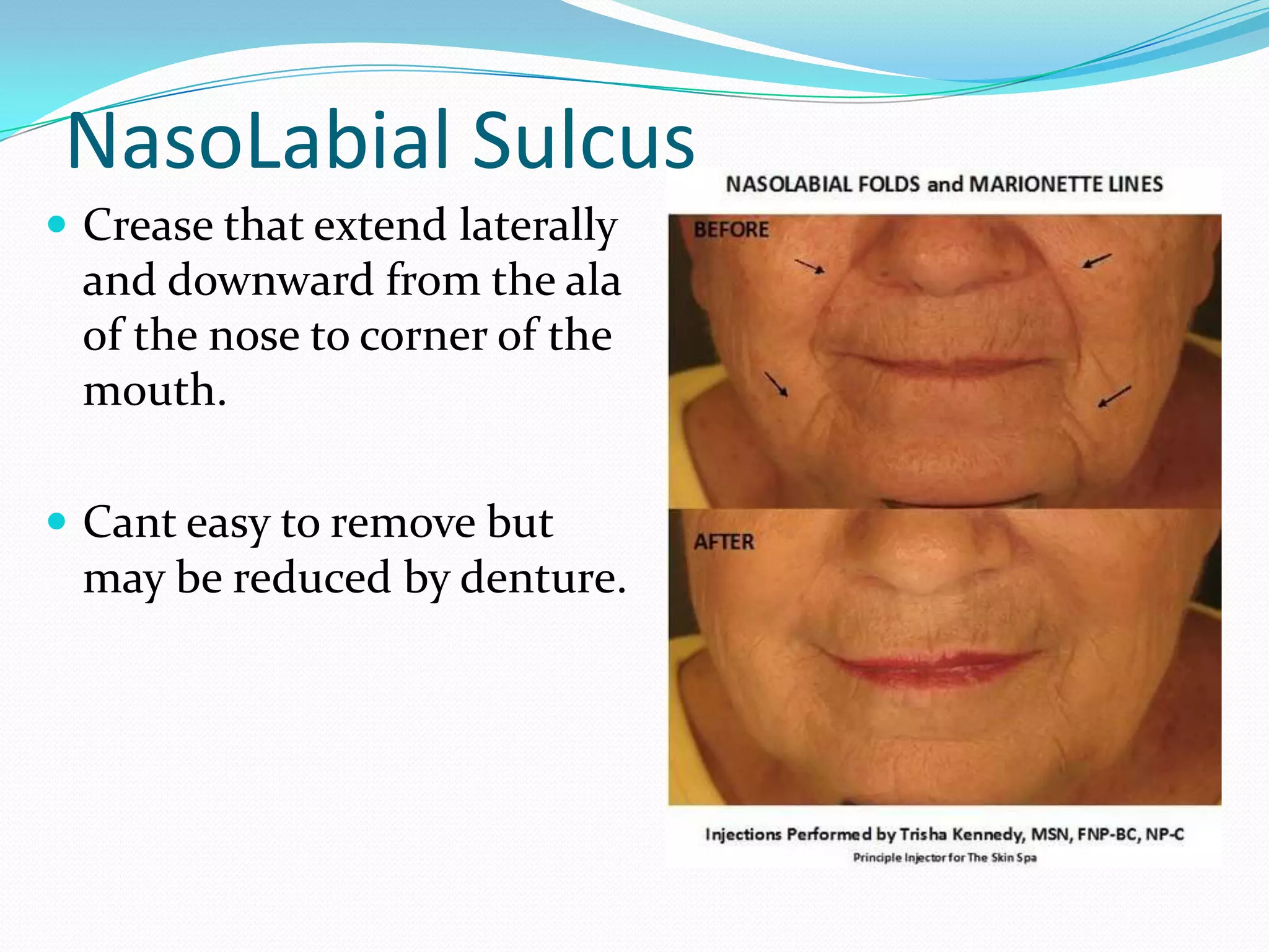 Anatomical Landmarks for Complete Dentures | PPTX