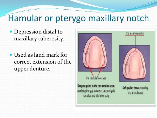 Hamular Notch Anatomy For Complete And Partial Dentures Ppt Download