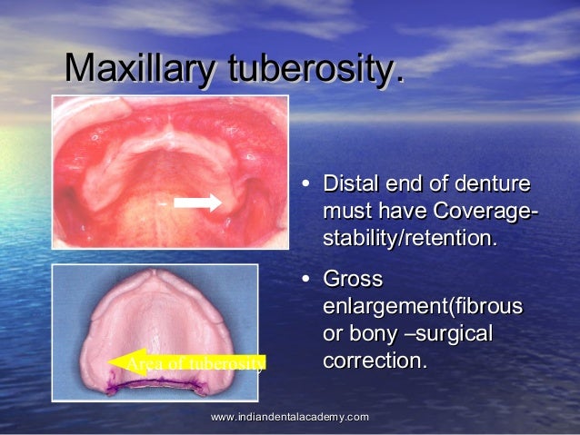 Anatomical landmarks/ dental implant courses by Indian dental academy